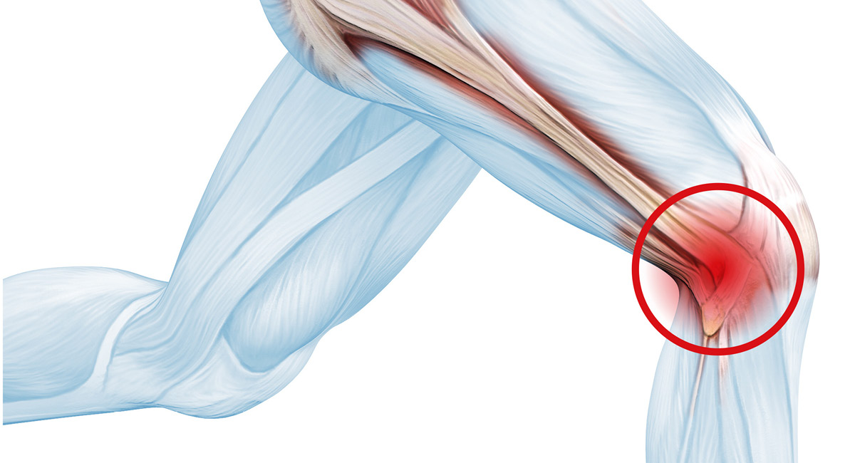 Running and IT Band Pain | IMPACT Magazine